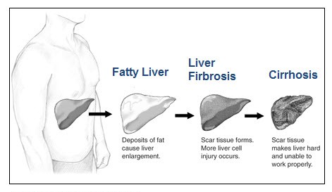Alcoholic Liver Disease | UCSF MacKenzie Lab